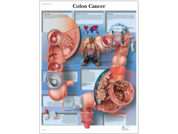Anatomical Chart - Colon Cancer - A-1 Medical Integration