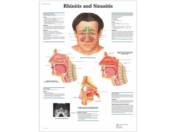 Anatomical Chart - Rhinitis and Sinusitis - A-1 Medical Integration